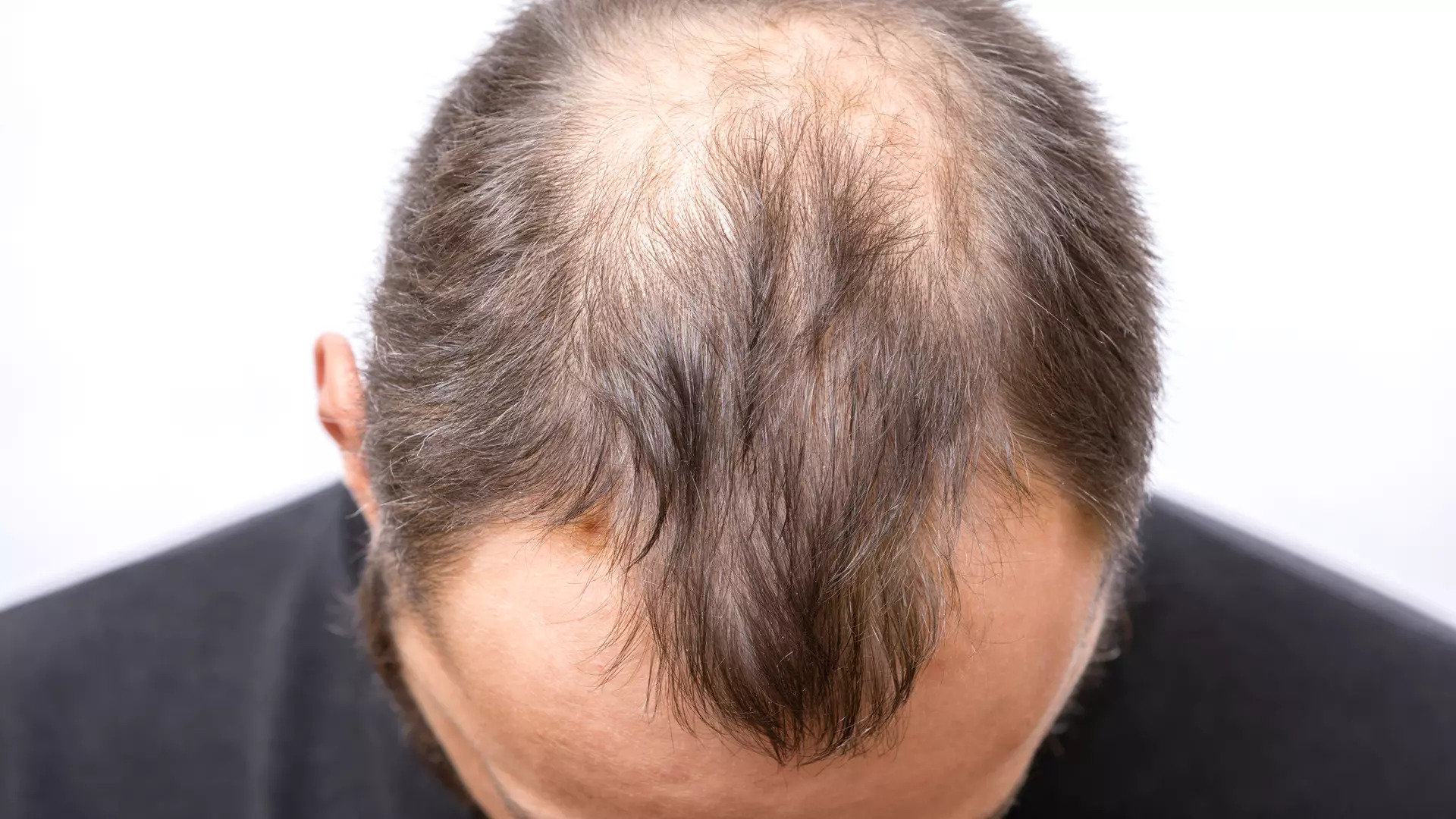 Best Hairline Restoration St Louis, MO | Synergi Facial Surgery